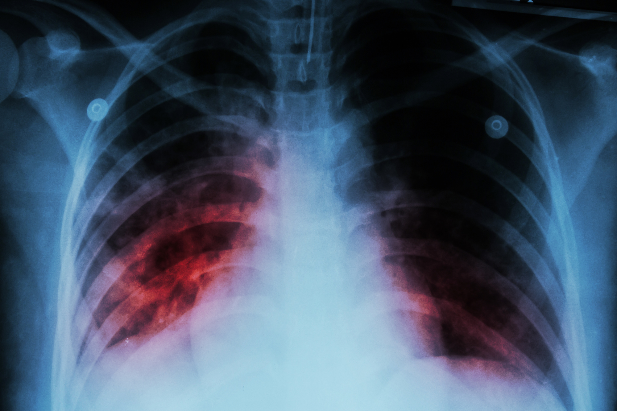 How To Tell The Difference Between The Two Types Of TB
